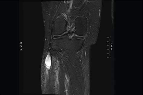 Ganglion Cyst Adjacent To Proximal Tibiofibular Joint
