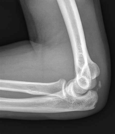 Types Of Elbow Fracture At Annette Nelson Blog