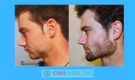 How To Mew Properly Step By Step Guide CMH HEALTHS