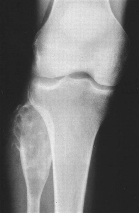Fibrous Dysplasia Of Bone