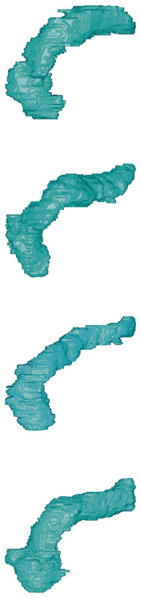 Comparisons Of 3d Pancreas Segmentations From The Proposed Dunet With