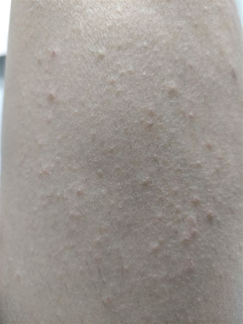 Is This An Hiv Rash Appeared 1 Month After Sex With Stranger It Was Insertive Vaginal Sex With