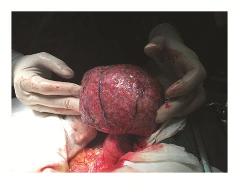 Gastrointestinal Bleeding Is An Independent Risk Factor For Poor Prognosis In Gist Patients