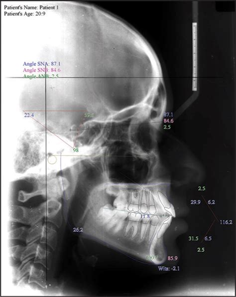 An Evaluation Of The Reproducibility Of Landmark Identification In Traditional Versus Computer
