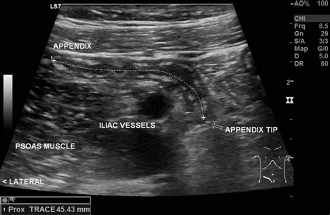 Ultrasound 7 Acute Appendicitis Emhum