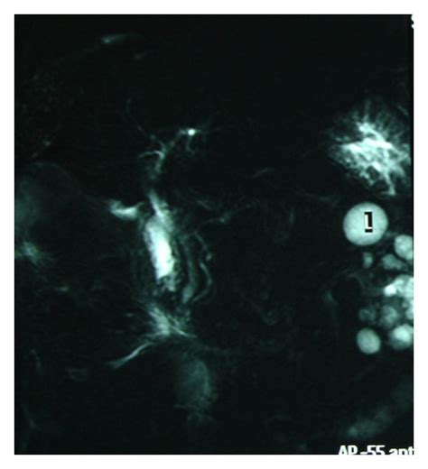 Mrcp Demonstrating Normal Appearance Of The Biliary Tree Download Scientific Diagram