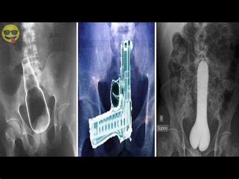 Xrays Of Objects Stuck Inside People Bottoms Up 6 Strange Things