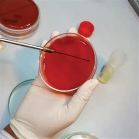 Ascitic Fluid Culture And Sensitivity Test In Delhi Ncr India Gdic