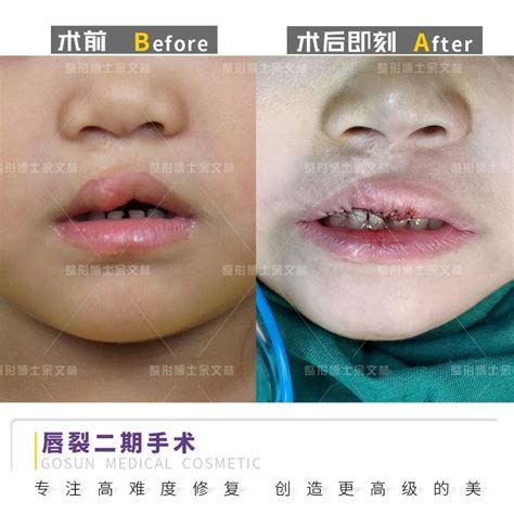 一期唇裂修复术后，会出现哪些继发畸形？ 知乎