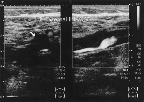 Ultrasound Of The Pelvis And Groin Showing Occlusion Of The External