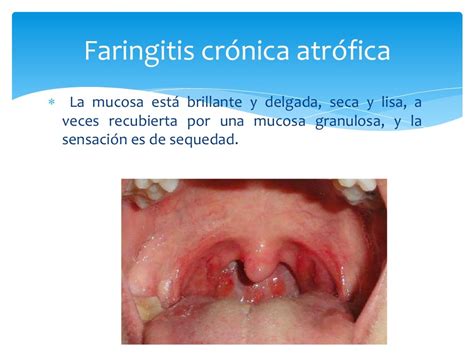 La Faringitis Viral Faringitis Viral Síntomas Causas Y Cómo