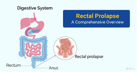 Rectal Prolapse Causes Symptoms Diagnosis And Treatment