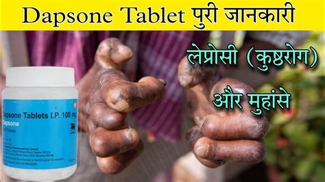 Dapsone Tablet Uses Dose Side Effects Precautions Youtube