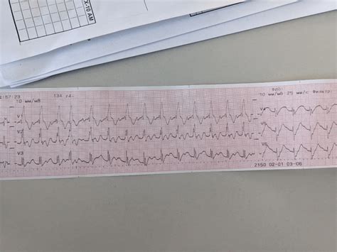 Sinus Tach Or A Flutter Rekgs