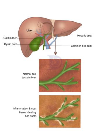 Primary Biliary Cholangitis Digestive And Liver Health Specialists