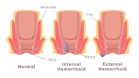 Do Hemorrhoids Itch Yes — And Heres How To Fix It Womans World