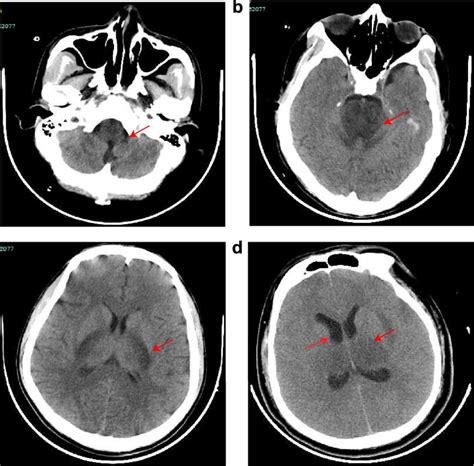 Abnormal Head Ct Imaging Head Ct Appearance Of The Medulla Oblongata Download Scientific