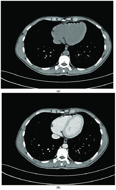 A Pre Hbo Chest Ct Scan Wo Contrast Medium And B With Contrast