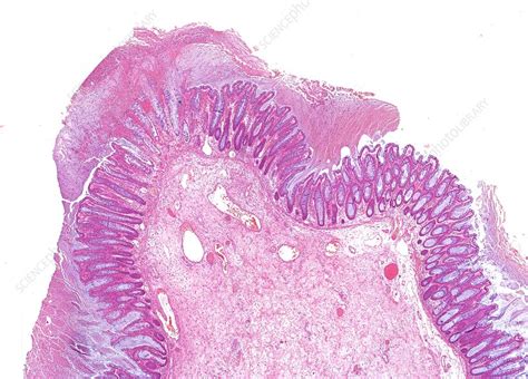 Colitis Light Micrograph Stock Image C023 9475 Science Photo Library