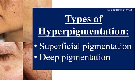 Hyperpigmentation Disorders Causes Types Treatments Dr Rachel Ho