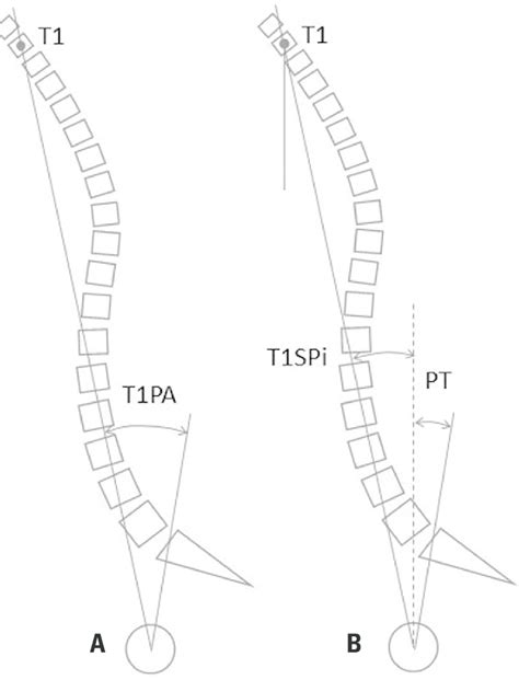 The T1 Pelvic Angle T1pa A Is The Morphologic Parameter For Global Download Scientific