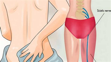 Sciatic Pain చాలా మందిని ఇబ్బంది పెట్టే తుంటి నొప్పికి కరెక్ట్
