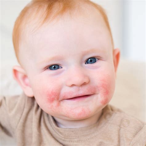 Най разпространеният дерматологичен проблем при децата е атопичната кожа