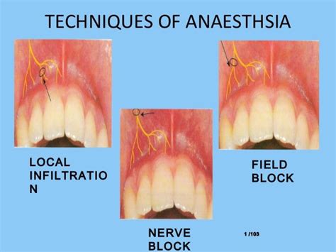 Local Anesthesia