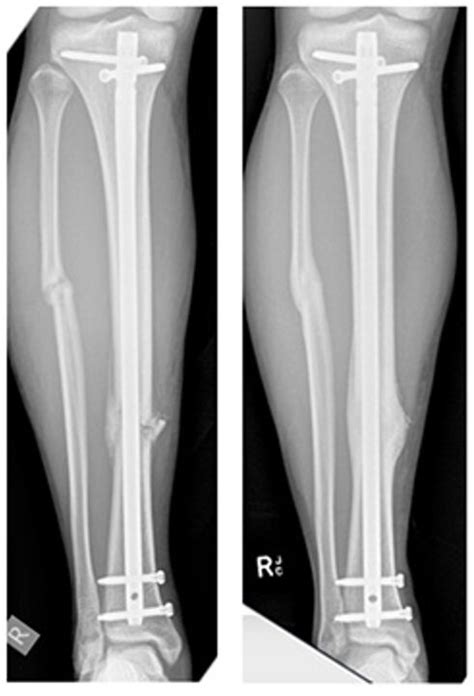 Fractured Tibia Treatments Fractured Tibia Treatments