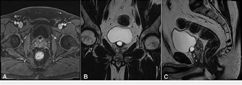 Pelvic Mri Image Showing An Anteriorly Positioned Midline Prostatic Download Scientific Diagram
