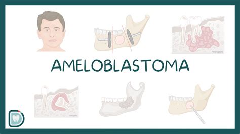 Unicystic Ameloblastoma Treatment Histopathology Of Ameloblastoma Of