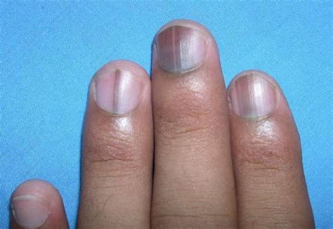 Ringworm Fingernails Tinea Infections Understanding Ringworm And Its Various Types