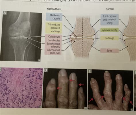 Diseases Of The Joints Flashcards Quizlet