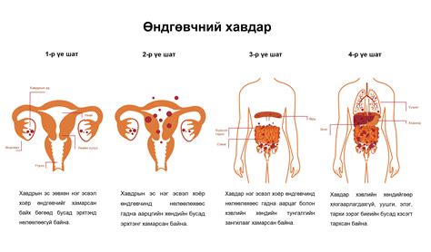 Өндгөвчний хорт хавдар