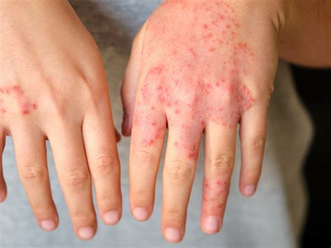 Beyond Corticosteroids Personalized Care For Individuals With Mild To Moderate Atopic