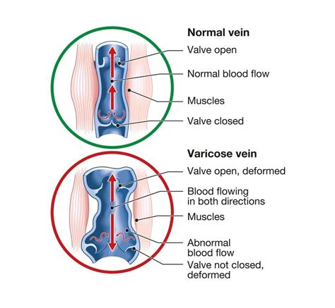 Varicocele Healing Ltd On Linkedin Cooling Mesh To Lower Testicular Temperature 🧊
