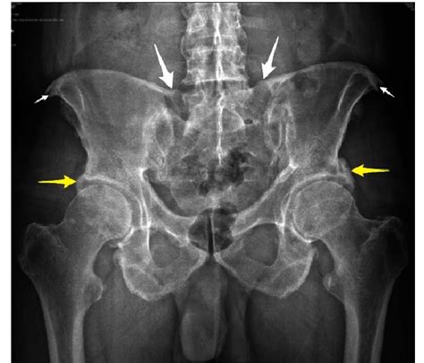 Anteroposterior Ap Radiograph Of The Pelvis Shows Calcification Of Download Scientific