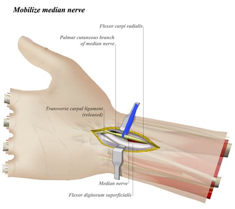 Volar Approach To Wrist Approaches Orthobullets