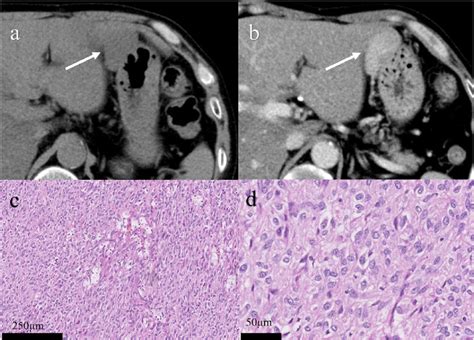 Low Risk Gastrointestinal Stromal Tumor Epithelioid Cell Type A Download Scientific Diagram