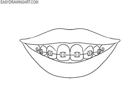 How To Draw Braces Artofit