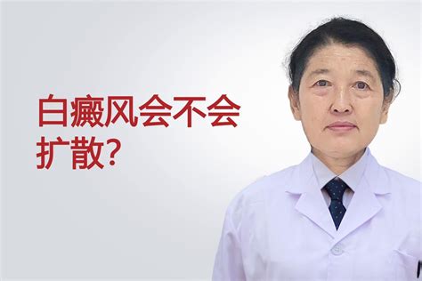 台州京科白癜风朱桂莲医生讲解白癜风会不会扩散 凤凰网视频 凤凰网