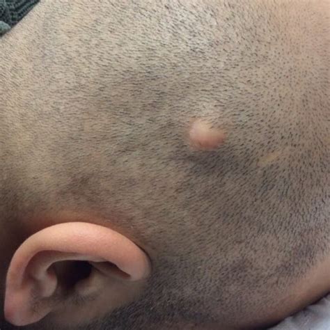 Pilar Cyst Removal Causes Treatment Options And Recovery