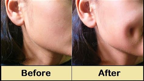 How To Get Dimples Fast Naturally Simple Facial Exercise To Get Dimples Without Surgery