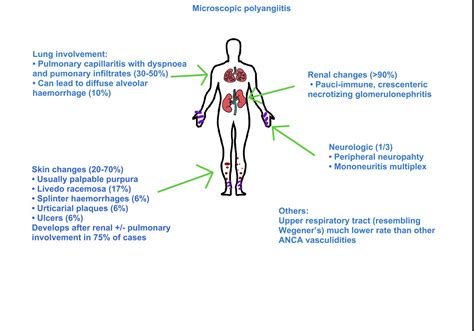 Vasculitis — Irish Derm Tutor