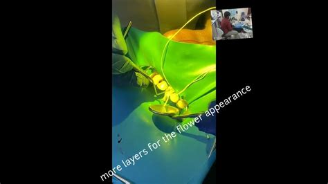 Ribbond Post Monoblock Post N Core Adhesive Dentistry Youtube