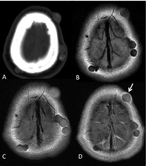 Figure 7 From Beyond The Skull Ct And Mri Findings In Lesions Of The Scalp In Adults A