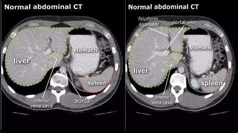 Liver Segment Anatomy Ct Scan Pptx
