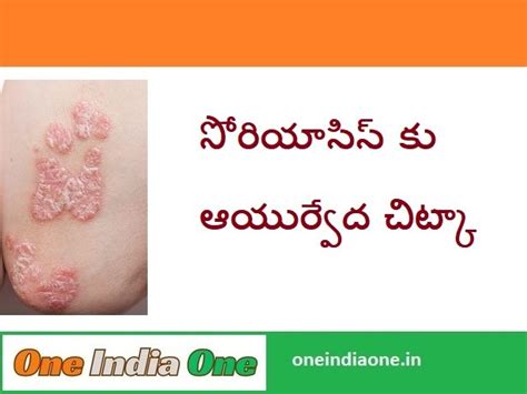 Psoriasis సోయాసిస్ర కరకాల చర్మ సమస్యల్లో సోయసిస్ ఒకటి