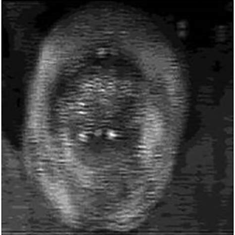 Cervical Cancer Detection Using Fuzzy Logic And Classification Method