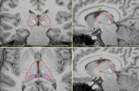 Frontiers Responsive Neurostimulation Targeting The Anterior Centromedian And Pulvinar